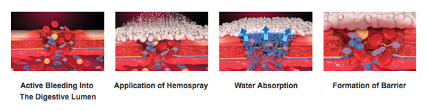 Hemospray – the next generation in haemostasis therapy | Endoscopy